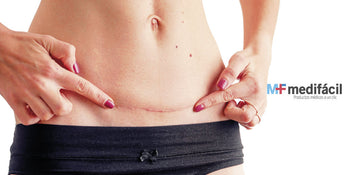 Cicatriz de Cesárea: Cómo Cuidarla - Medifácil